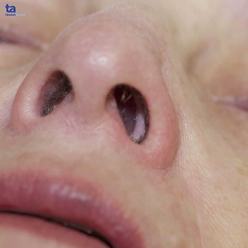 Bệnh Polyp mũi là gì | Những điều bạn cần phải biết