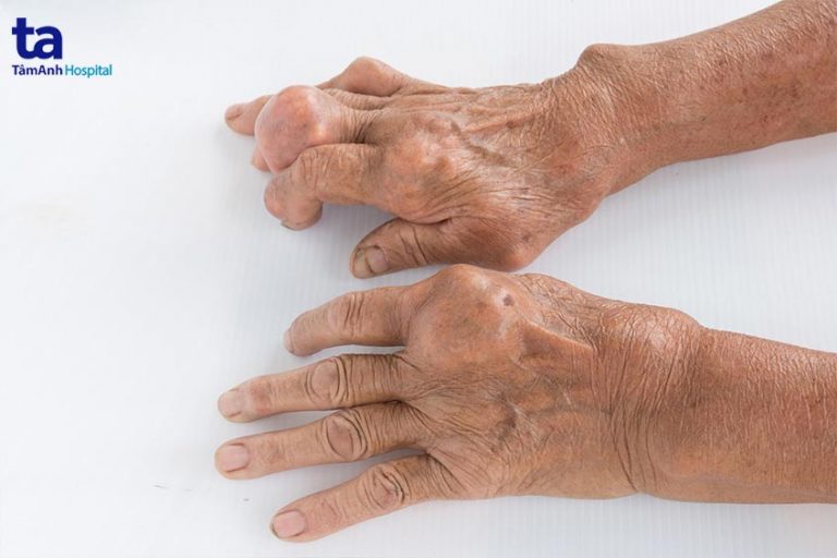 Hạt tophi (Nốt tophi): Nguyên nhân, triệu chứng và điều trị