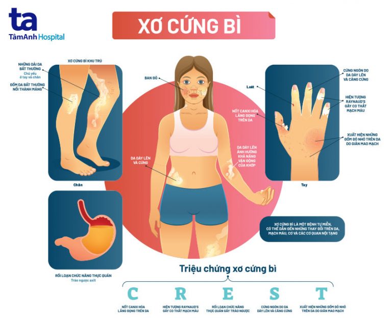 Xơ cứng bì toàn thể là gì? Nguyên nhân, biểu hiện và cách điều trị