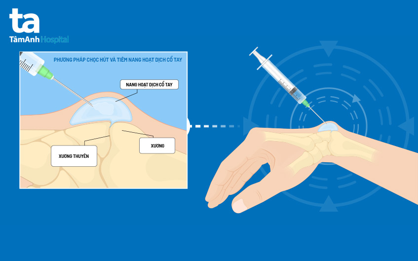 Tiêm khớp cổ tay là gì? Chỉ định và quy trình thực hiện