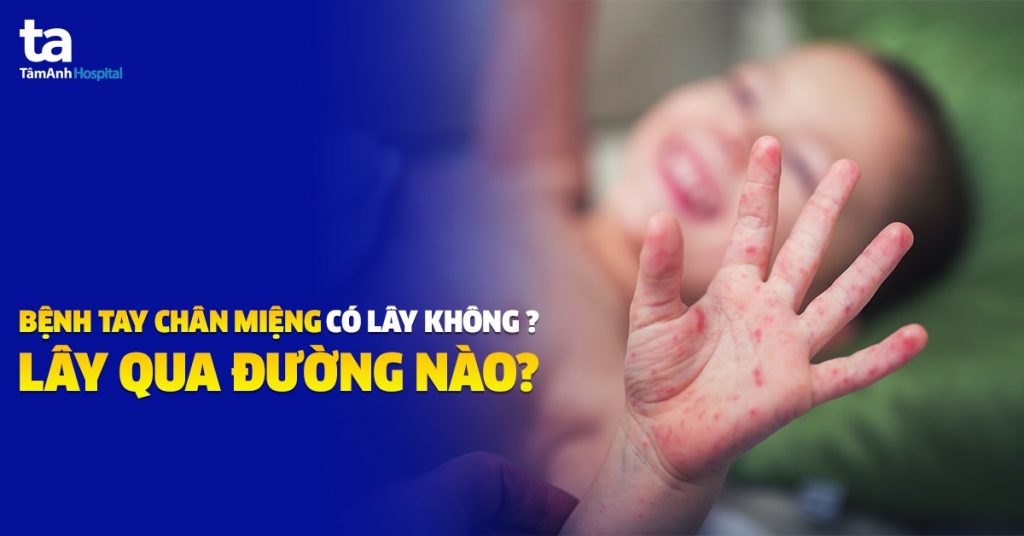 Tay chân miệng có lây không? Lây qua đường nào?