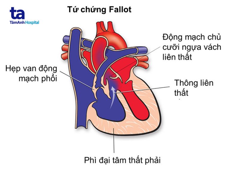 Phương pháp chẩn đoán & điều trị tứ chứng Fallot