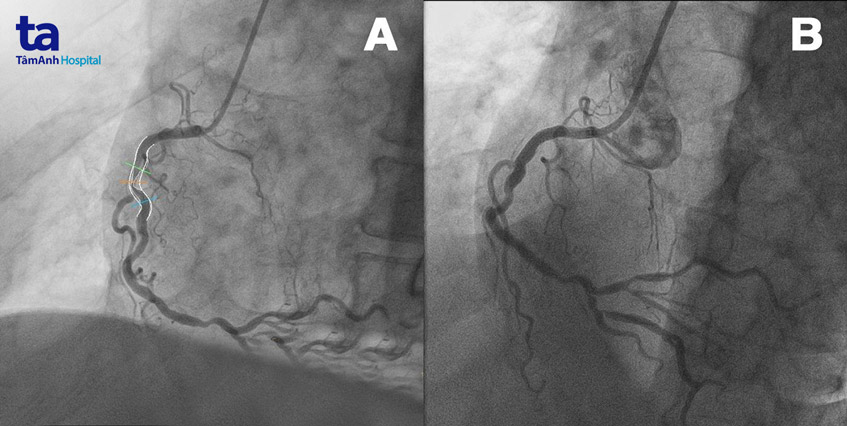 Tái thông 3 nhánh mạch vành hẹp nặng cho cụ ông 80 tuổi từ Campuchia ...
