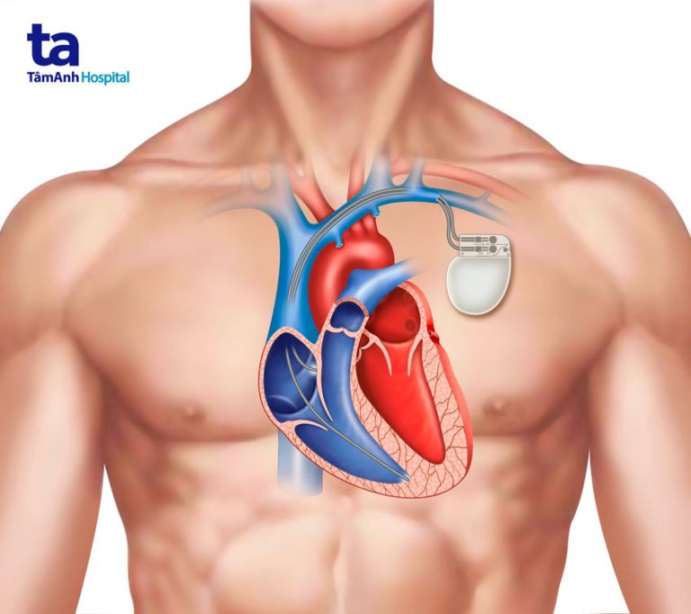 Suy tim phải: Nguyên nhân, triệu chứng, chẩn đoán, điều trị