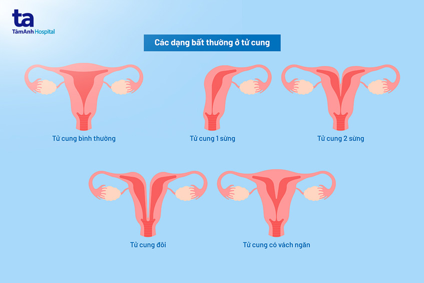 Hiểu đúng về u xơ tử cung để phòng ngừa và điều trị hiệu quả