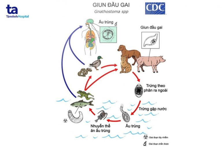 Bệnh giun đầu gai: Nguyên nhân, triệu chứng, điều trị và phòng ngừa