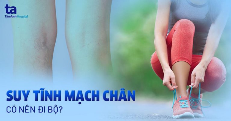 Bị suy giãn tĩnh mạch chân có nên đi bộ không? Cần lưu ý điều gì?