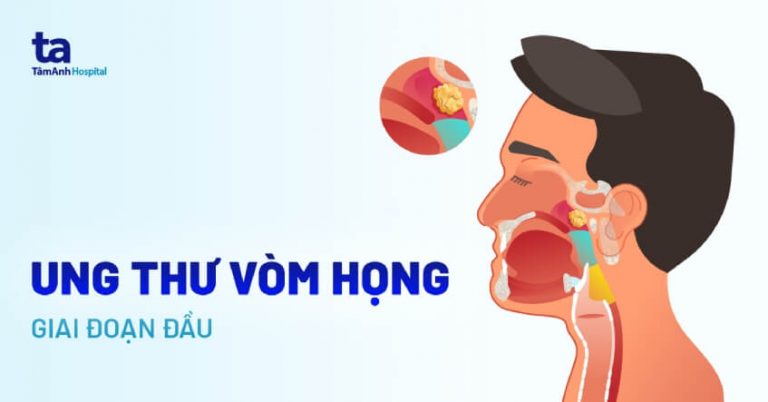 Ung thư vòm họng giai đoạn đầu: Dấu hiệu, chẩn đoán và điều trị