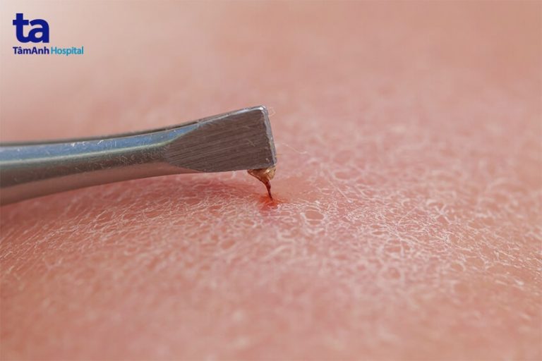 Cách sơ cứu ong đốt: Hướng dẫn xử trí đúng cách ngay tại nhà