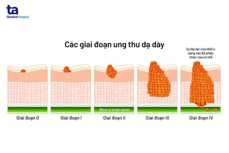 5 giai đoạn ung thư dạ dày: Cách đánh giá và chẩn đoán chi tiết