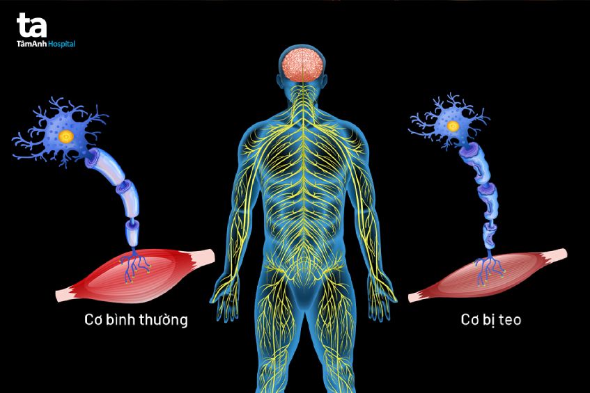 Bệnh teo cơ do đái tháo đường: Nguyên nhân và triệu chứng
