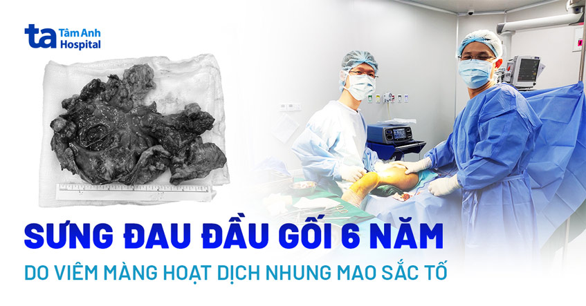 6 năm sưng đau đầu gối do viêm màng hoạt dịch