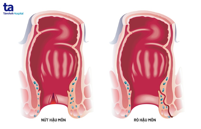 Chụp MRI rò hậu môn: Quy trình thực hiện và ưu nhược điểm
