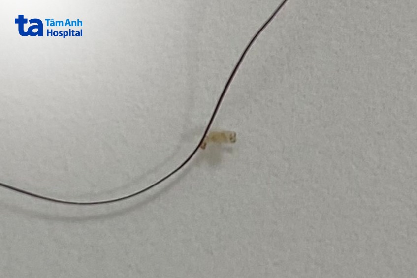 Ngứa ngáy dữ dội mất ngủ vì rận mu