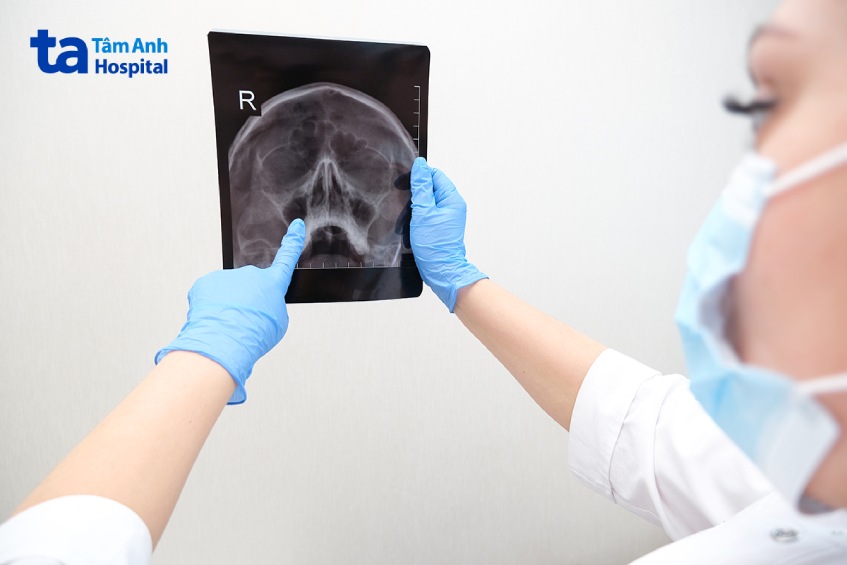 Chụp X quang xoang: Các tư thế chụp, quy trình và ưu nhược điểm