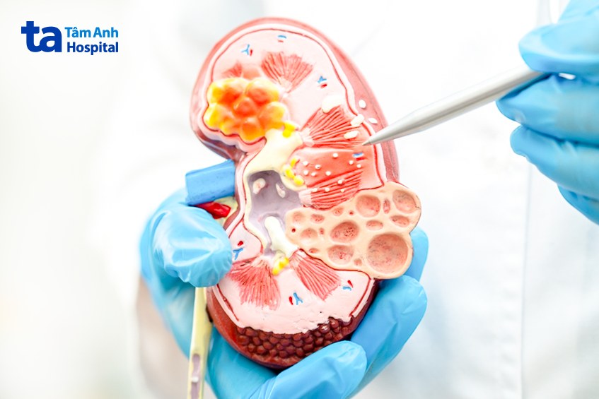 Bướu thận: Nguyên nhân, triệu chứng, chẩn đoán, điều trị