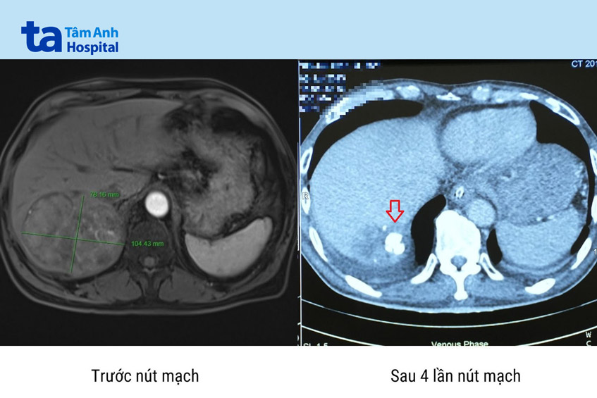 Nút mạch thu nhỏ ngoạn mục ung thư gan kích thước lớn