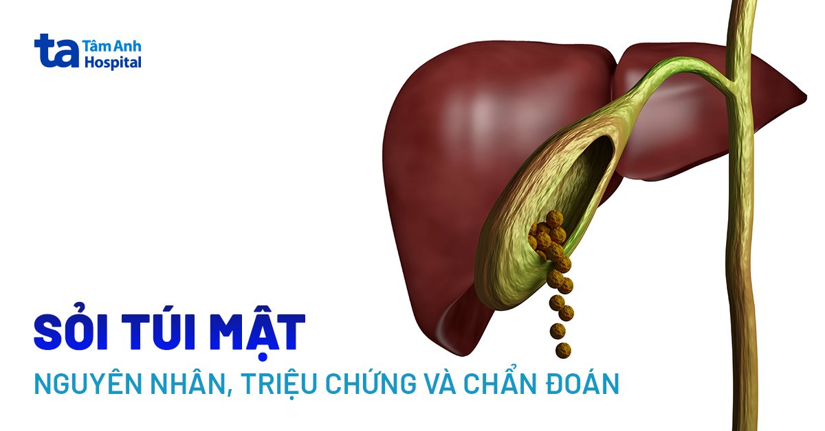 Sỏi túi mật: Nguyên nhân, triệu chứng, chẩn đoán và phòng ngừa