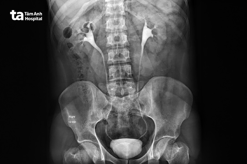 X quang sỏi thận: Quy trình, hình ảnh và các phương pháp chụp