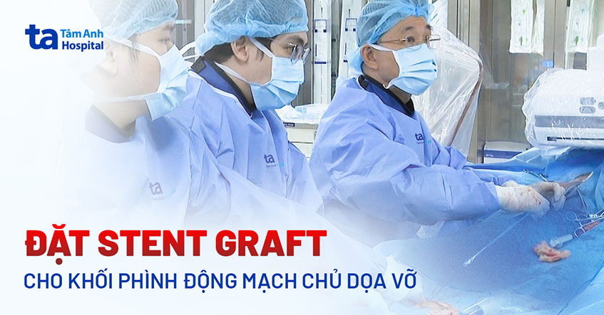 Đặt stent graft cho bệnh nhân dọa vỡ khối phình động mạch chủ bụng