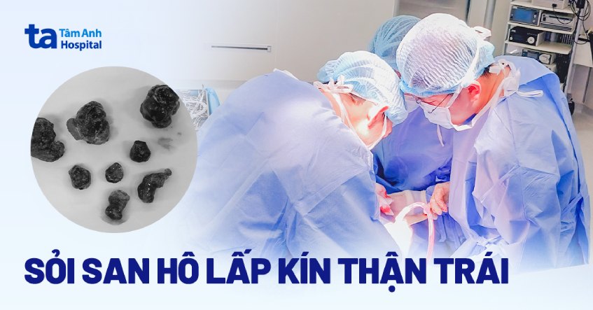 Sỏi san hô lấp kín thận, có viên to bằng ngón chân cái