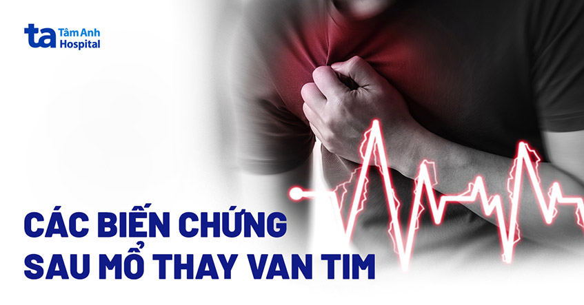 10 biến chứng sau thay van tim có thể gặp? Làm sao giảm rủi ro?