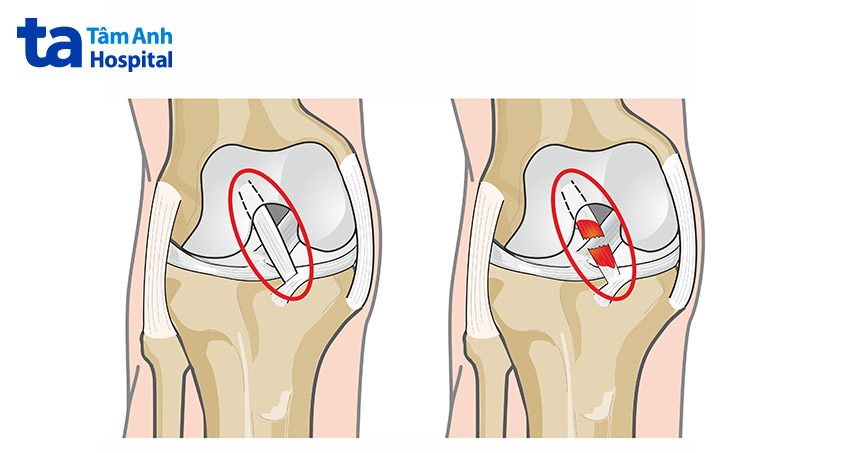 Đầu gối: Giải phẫu cấu tạo, chức năng và những điều cần biết