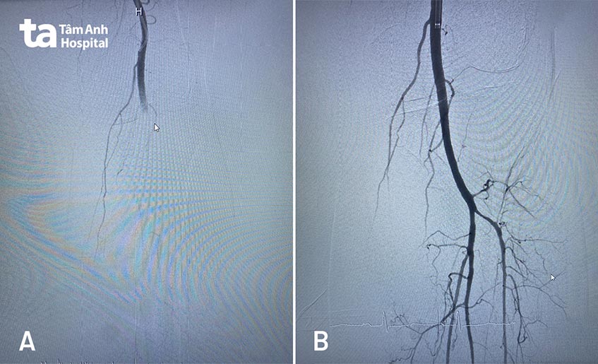 Suýt phải cắt chân vì huyết khối lấp kín động mạch khoeo đùi