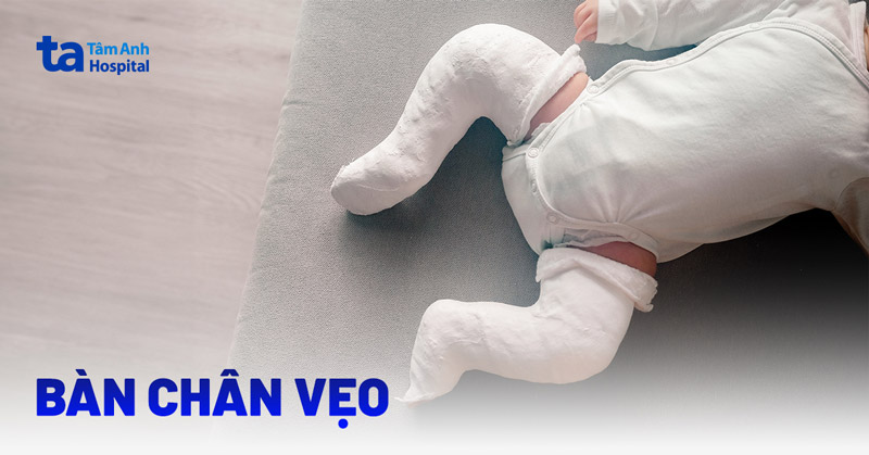 Dị tật bàn chân vẹo: Nguyên nhân, phân loại, dấu hiệu, điều trị