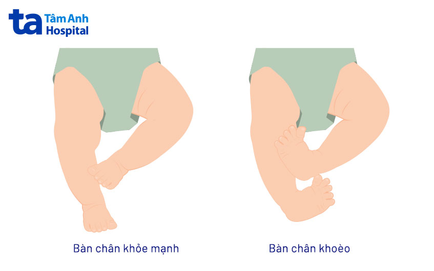 Khoèo chân ở trẻ sơ sinh: Nguyên nhân, dấu hiệu và cách điều trị