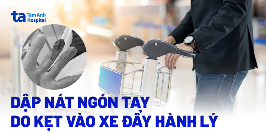 Khách ngoại quốc dập nát ngón tay do kẹt vào xe đẩy hành lý