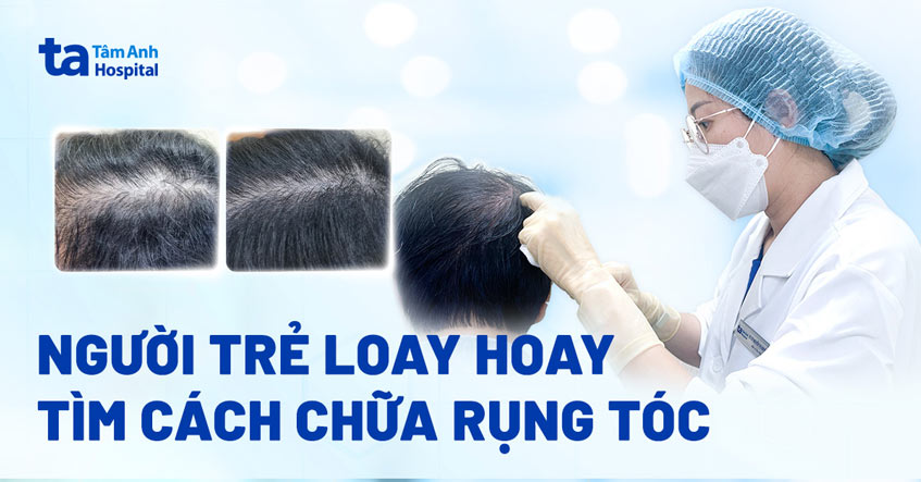 Người trẻ loay hoay tìm cách chữa rụng tóc | BVĐK Tâm Anh