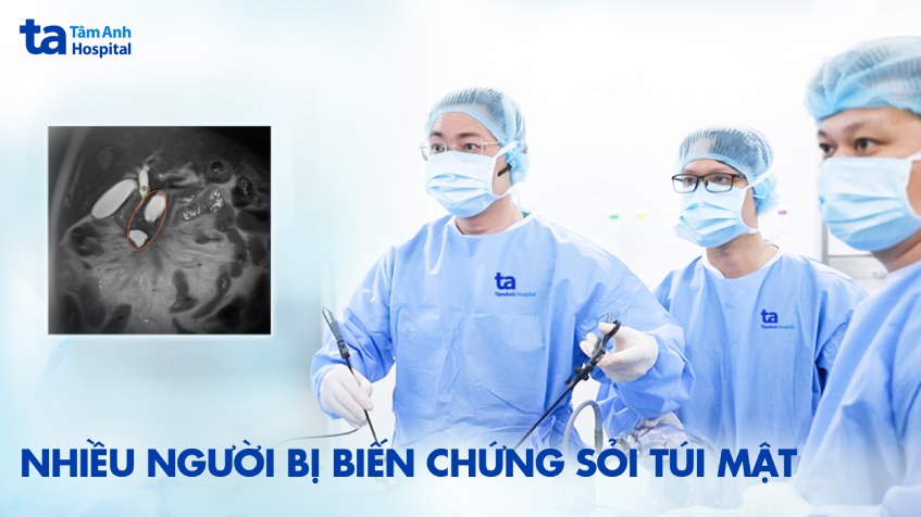 Nhiều người bị biến chứng sỏi túi mật | Bệnh viện Đa khoa Tâm Anh