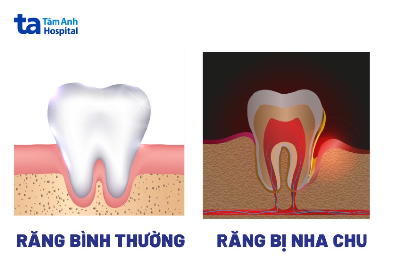 Túi nha chu là gì? Nguyên nhân, triệu chứng và cách điều trị