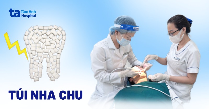 Cao răng (vôi răng) là gì? Nguyên nhân và quá trình hình thành