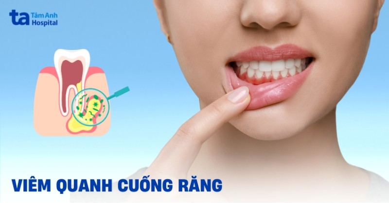 Cao răng (vôi răng) là gì? Nguyên nhân và quá trình hình thành