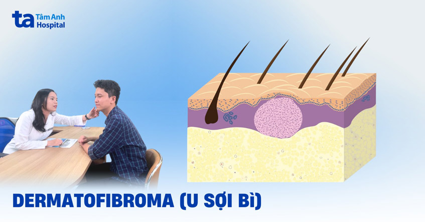 Mụn bọc ở mũi: Nguyên nhân, triệu chứng, chẩn đoán, phòng ngừa