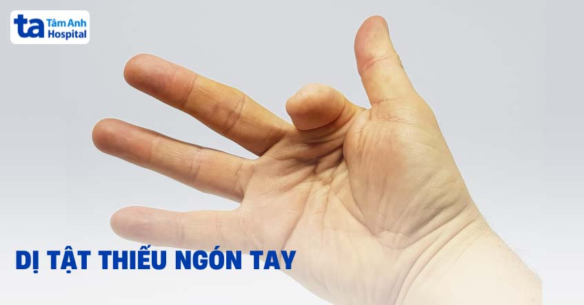 Dị tật thiếu ngón tay: Nguyên nhân, dấu hiệu, chẩn đoán và điều trị