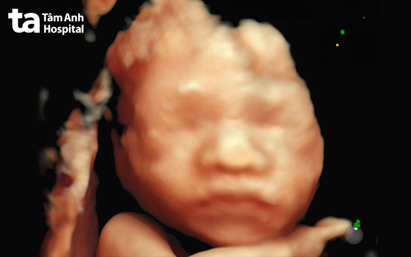 Quyết định khó khăn của người mẹ mang gen xương thủy tinh