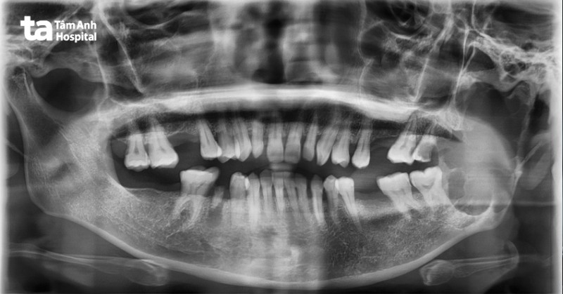 Nang thân răng là gì? Có nguy hiểm không? Cách điều trị