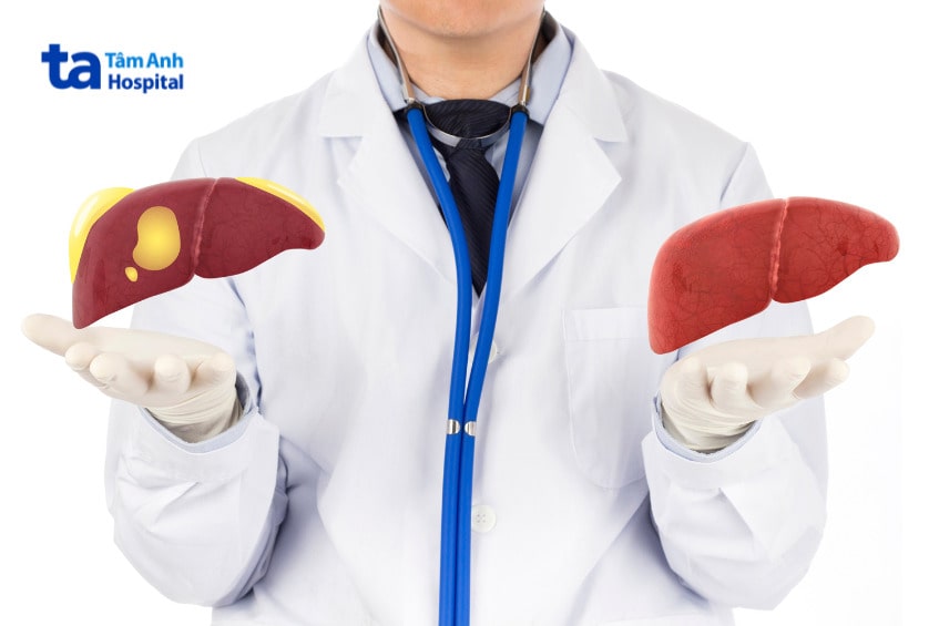 Thuốc Livolin H 300mg: Công dụng, liều dùng, giá bao nhiêu?