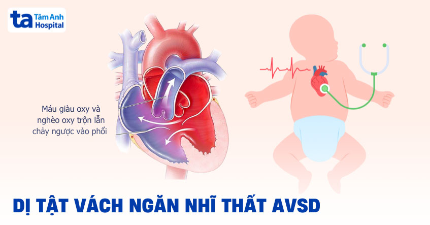 Khiếm khuyết vách ngăn nhĩ thất - AVSD là gì? Có chữa được không?