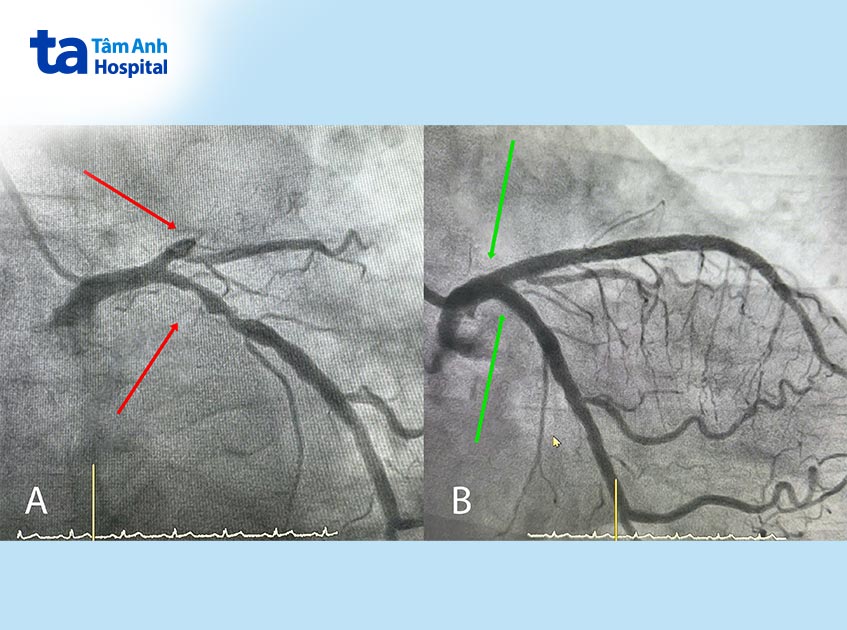 Mổ cột sống phát hiện thiếu máu cơ tim nặng