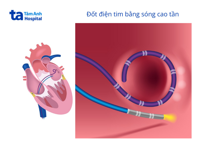 Đốt điện tim là gì? Ưu điểm, chỉ định, quy trình và lưu ý [A-Z]