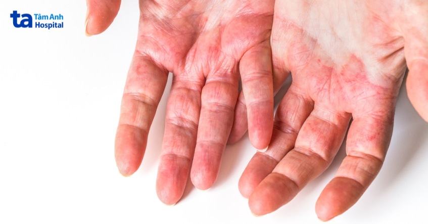 Viêm da cơ địa ở tay: Nguyên nhân, dấu hiệu và cách điều trị