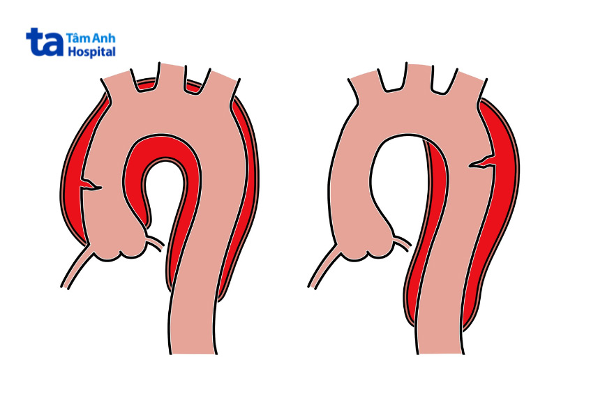 Stent graft là gì? Vai trò, cấu tạo và chức năng hoạt động