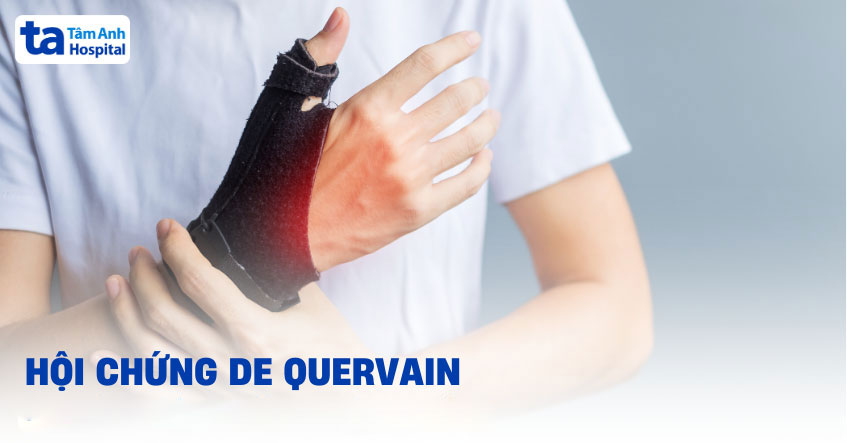 Hội chứng De Quervain: Nguyên nhân, triệu chứng và cách phòng tránh