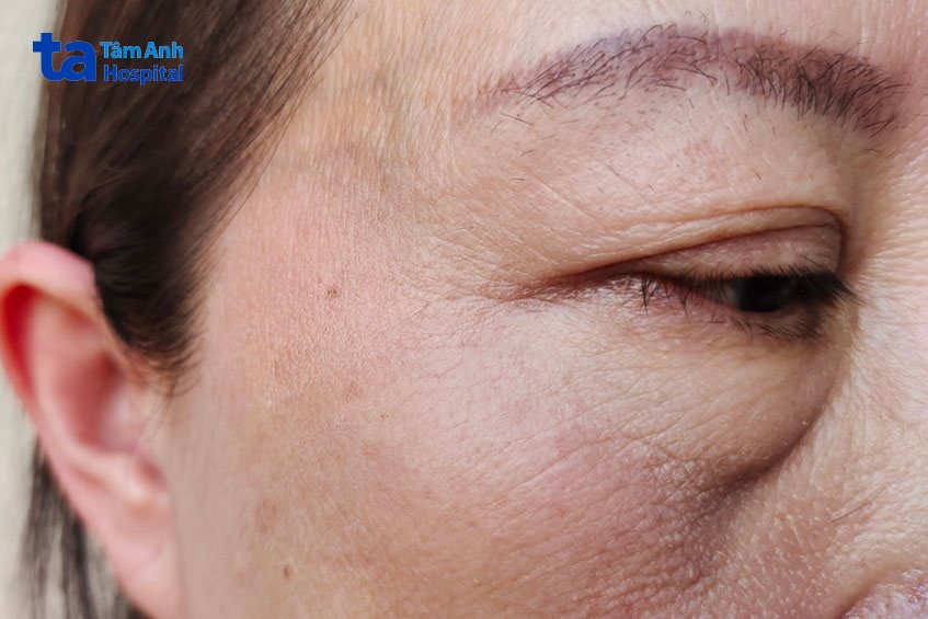 5 cách chữa sụp mí mắt đơn giản tại nhà giúp người bệnh mau hồi phục