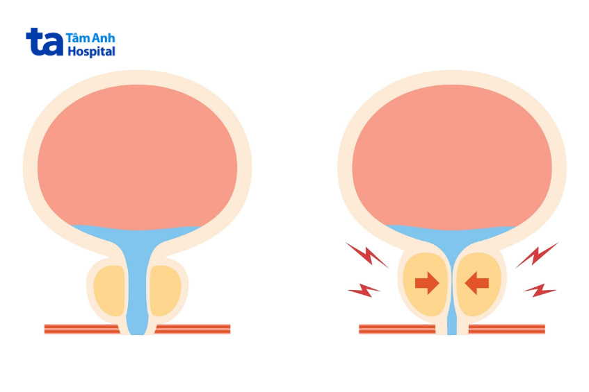 Thuốc Harnal Ocas 0.4mg: Công dụng, liều dùng, tác dụng phụ, giá