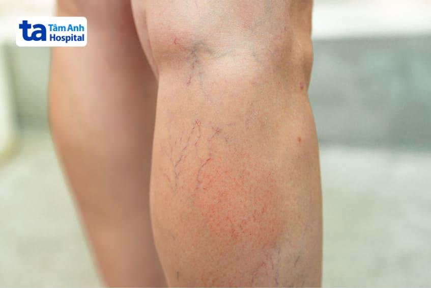 Thuốc Aescin 20mg: Công dụng, liều dùng và cách sử dụng